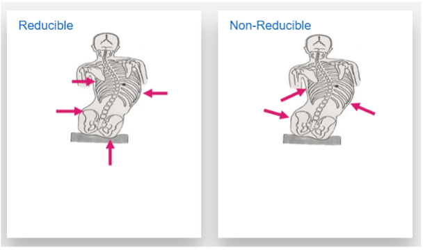 AT considerations for scoliosis posture